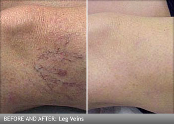 Thread Vein Removal